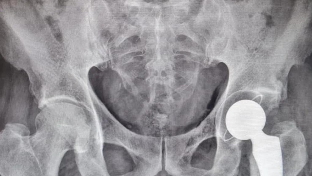 Realizan inédita operación de cadera en el hospital de Los Ángeles | La ...