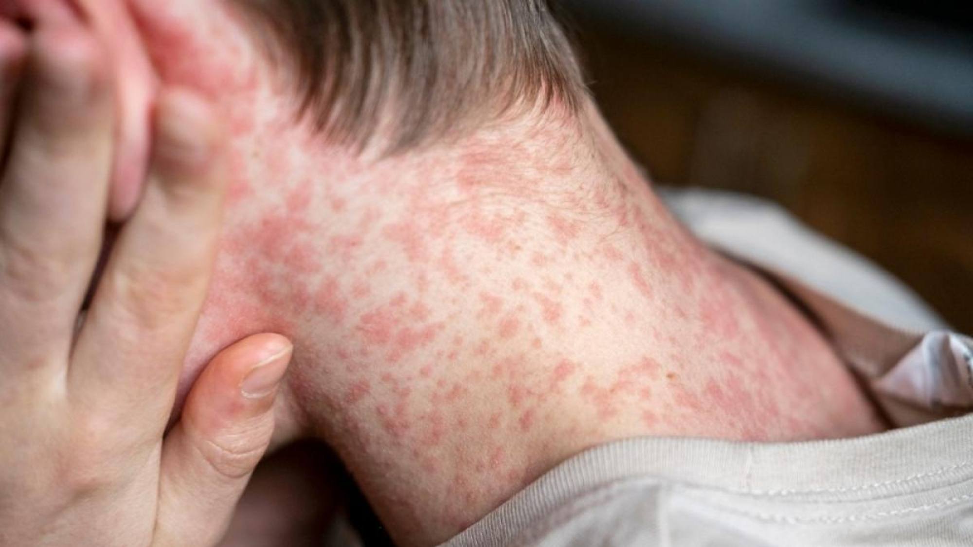 Alerta Por Sarampión Cómo Reconocer Los Síntomas Y Quiénes Están En